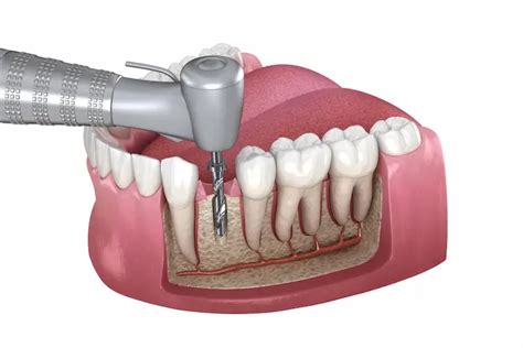 Post Root Canal Treatment Care And Precautions Alyans