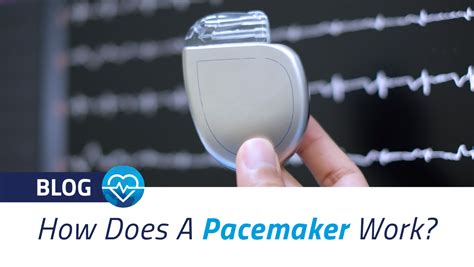 How Does A Pacemaker Work Forhearts Worldwide