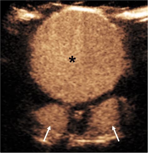 Ureter Insertion On Contrast Enhanced Voiding Urosonography In A Download Scientific Diagram