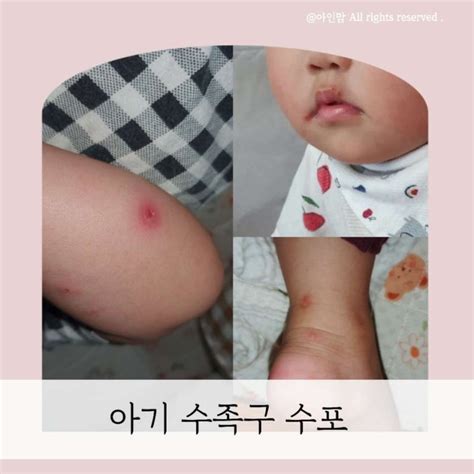 아기 수족구 수포 증상 완치까지 수족구 흉터 남음 네이버 블로그