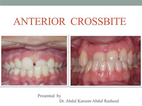 Anterior Crossbite Surgery Cost Dymfbr