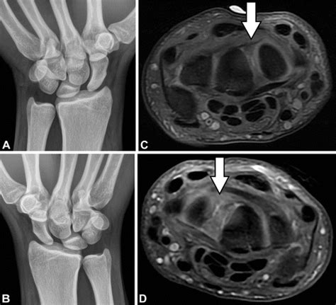 Scapholunate Dislocation
