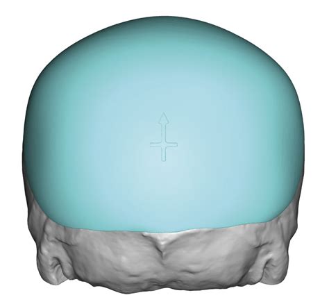 Custom Back Of The Head Skull Implant For Adult Male Brachycephaly