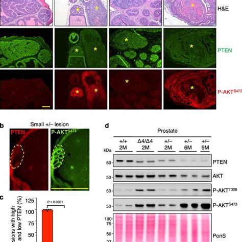 Pin Lesion Formation In Pten Males Is Characterized By Loss Of Pten