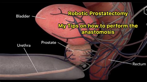 Radical Prostatectomy