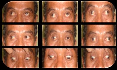Ocular Movements Showed Right Exotropia Download Scientific Diagram