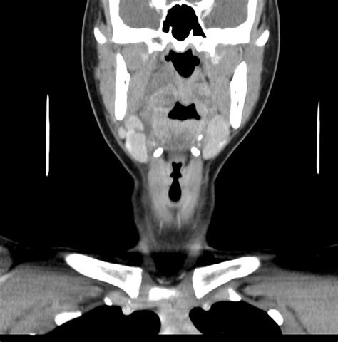 Acute Tonsillitis Pacs