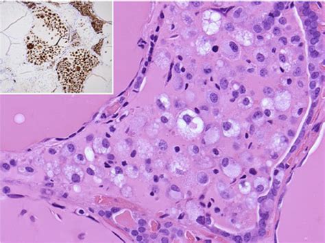 Intrafollicular Aggregates Of Macrophages With Follicular Disruption