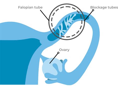 Hysterosalpingogram Hsg Testing In Flowood Ms