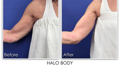 5 Halo Body Skin Rejuvenation Clinic Skin Rejuvenation Clinic