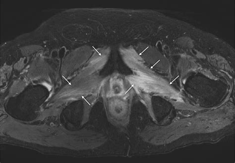 Acute Postradiation Lumbosacral Plexopathy Neurology