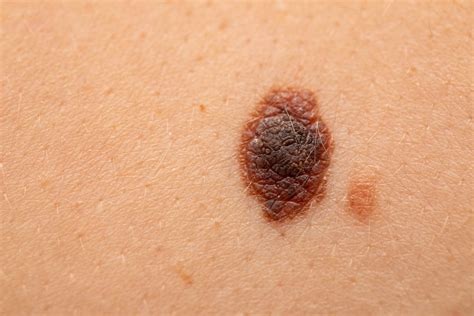 Benign Juvenile Melanoma