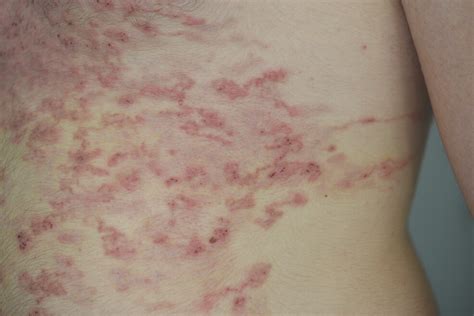 Cutaneous Larva Migrans Symptoms