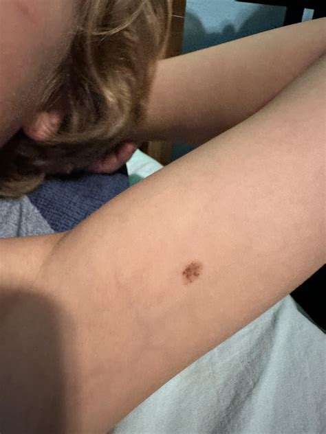 On My 8year Old Sons Arm Rmelanoma