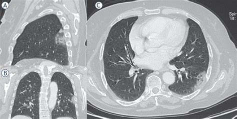 Woman 54 Year Ct Shows Patchy Consolidation In Apical Segment Of Left