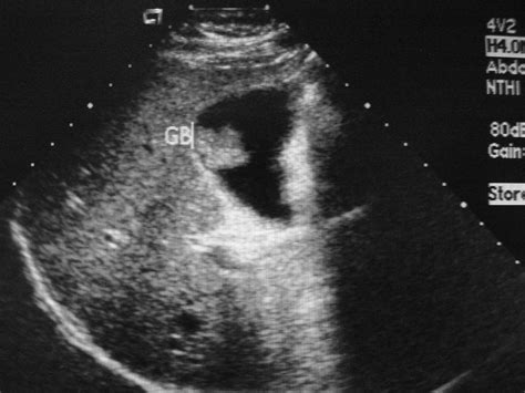 Gall Bladder Neoplasm 2561 Gall Bladder Polyp Cholesterol Surgery Photos