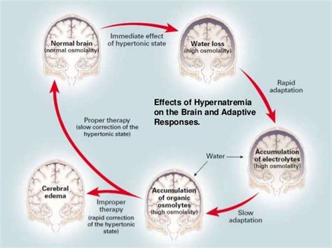 Hypernatremia Hypernatremia