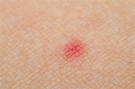 Picada De Aranha Sintomas Tratamentos E Prevenção Cuidados Pela Vida