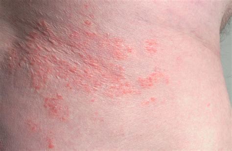 Psoriasis Rash Psoriasis Vs Tinea Versicolor Causes Symptoms And My XXX Hot Girl
