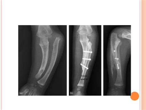 Forearm Reconstruction Ppt