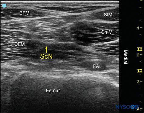 Ultrasound Guided Popliteal Sciatic Nerve Block Nysora