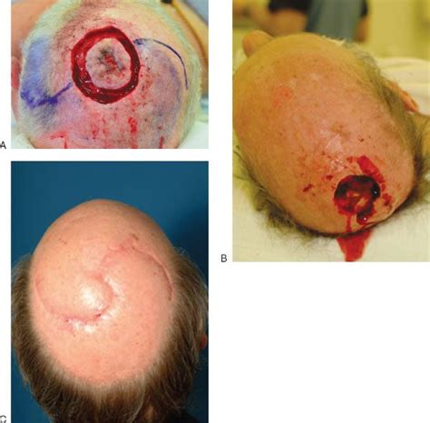 The Rectus Abdominus Free Flap And Its Variations Ento Key