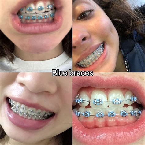 Ghim Của Eva Trên Braces Trong 2024