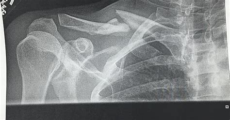 Collarbone Broken Into Three Pieces Have To Have Surgery Cant Lift Weight For Three Months I