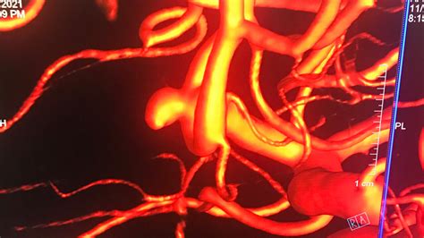 Mayshan Ghiassi On Linkedin Amazingneurovascularteam Neurosurgeon