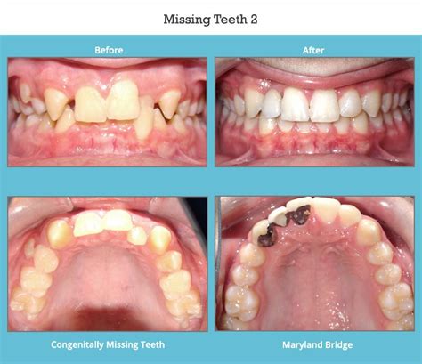 Missing Teeth — Meyer Orthodontics