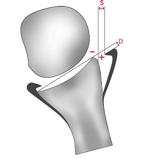Dislocation D And Separation S Of The Labrum In Relation To The