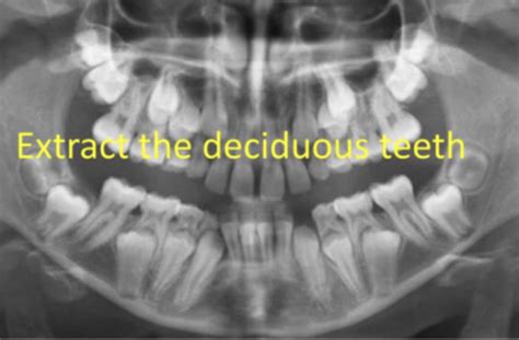 Orthodontics Common Eruption Problems And Their Management Flashcards
