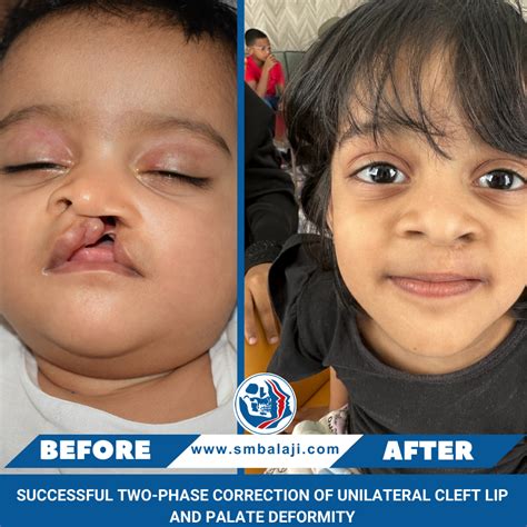 Best 13 Surgical Correction Of Unilateral Incomplete Cleft Lip