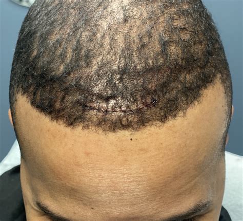 Forehead Reduction Incision Closure Dr Barry Eppley Explore Plastic