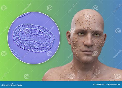 A Man With Smallpox Disease And Close Up View Of Variola Virus A Virus