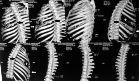 Three Dimensional Reconstruction Computed Tomogram Scan Of Chest