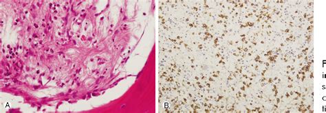 Figure 5 From Continuous Multiple Vertebral Compression Fractures In
