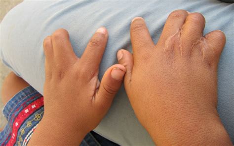 Syndactyly Is A Foetal Defect Science Is Brilliant