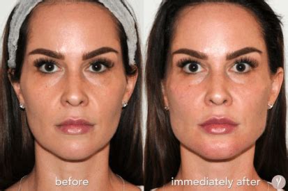 Y Lift® Treatment Pinnacle Dermatology