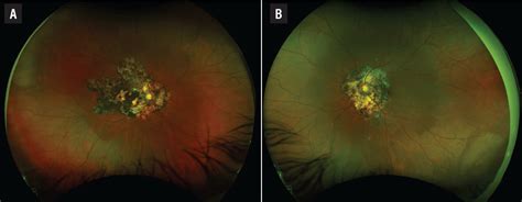 Slithering Toward The Fovea