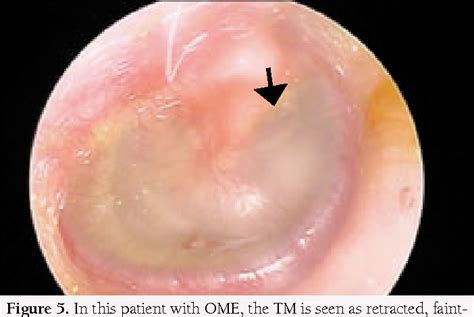 Otitis Externa With Effusion