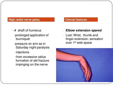 Causes Of Radial Nerve Palsy What Is Radial Nerve Palsy Ofkl