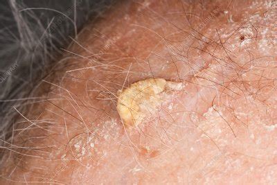 Cutaneous Horn Stock Image C0426336 Science Photo Library