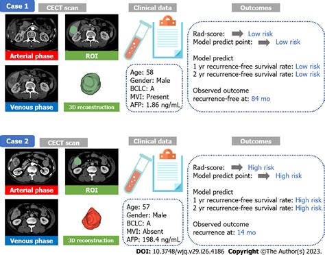 Radiomics Model Based On Contrast Enhanced Computed Tomography To
