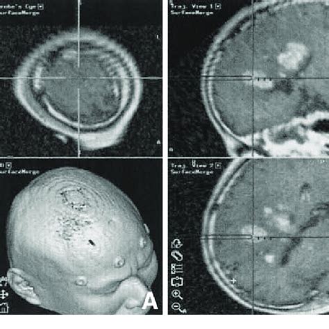 Neuronavigation System Images Demonstrating Before A And After B
