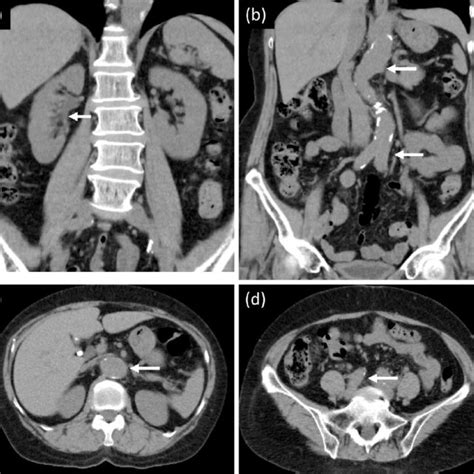 Figure2computed Tomography Findings After Treatment A Right