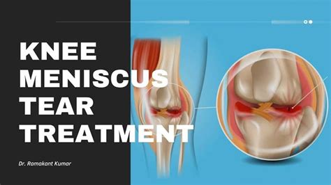 Meniscus Tears Causes Symptoms And Treatment Zfczbq