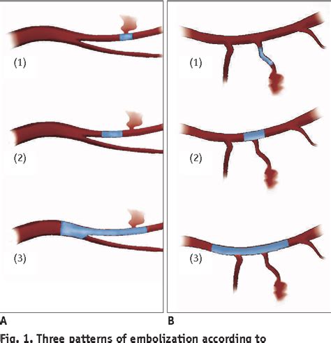 Figure 1 From Recent Update Of Embolization Of Upper Gastrointestinal Tract Bleeding Semantic