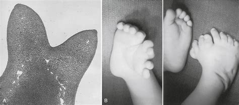 Limb Development Clinical Tree