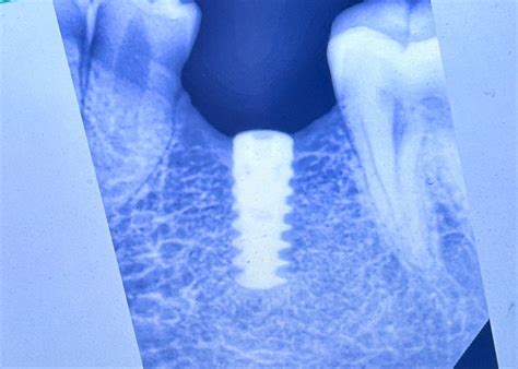 Todays Case Of Implant 2nd Stage Surgery ☺️ Clinical Tip Never